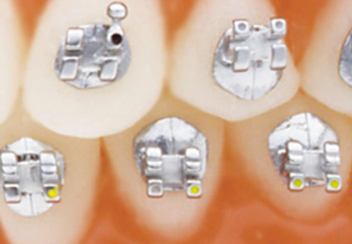 Metal orthodontic bracket - Orthos® - Ormco - twin