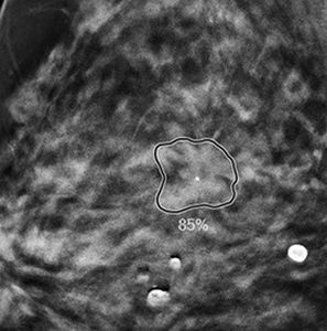 Mammography algorithm - ProFound AI® - iCAD - clinical / analysis ...
