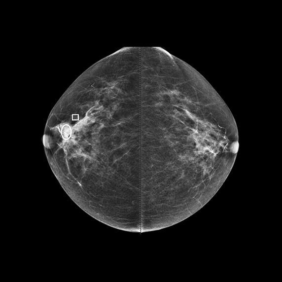 Clinical algorithm - SecondLook® - iCAD - for mammography / diagnostic / analysis