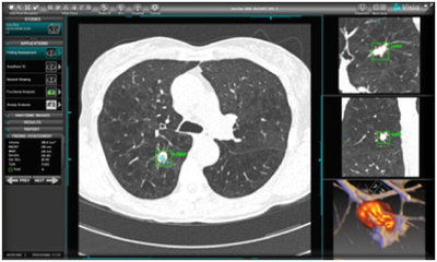 Analysis software - MeVis Medical Solutions AG - CAD / evaluation / for ...