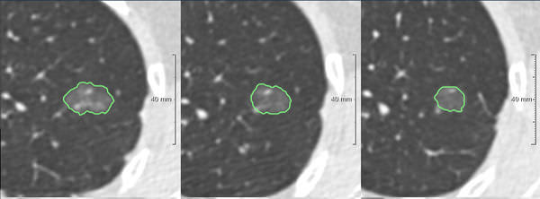 Diagnostic software - Veolity™ - MeVis Medical Solutions AG - CAD ...