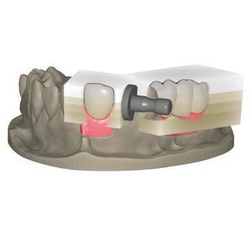 Design software module - In-Cad Nesting - Champions Implants GmbH ...