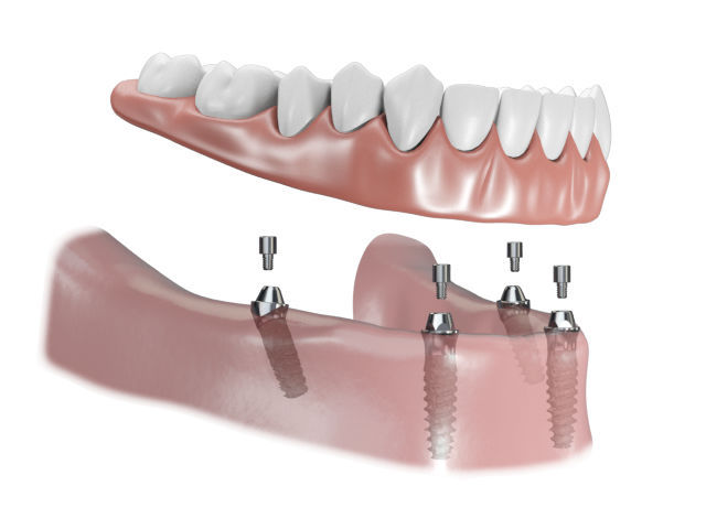 Straight implant abutment - MUA series - Ditron Dental - titanium ...