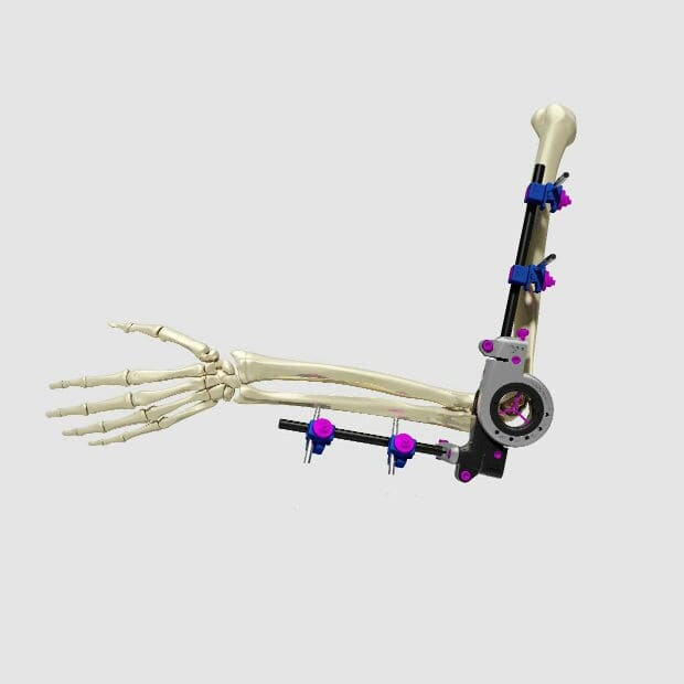 Elbow external fixation system - UniX® PDF - Response Ortho - tubular ...