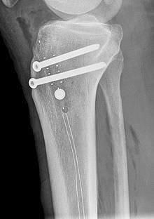 Tibia intramedullary nail - CarboFix Orthopedics - proximal / distal