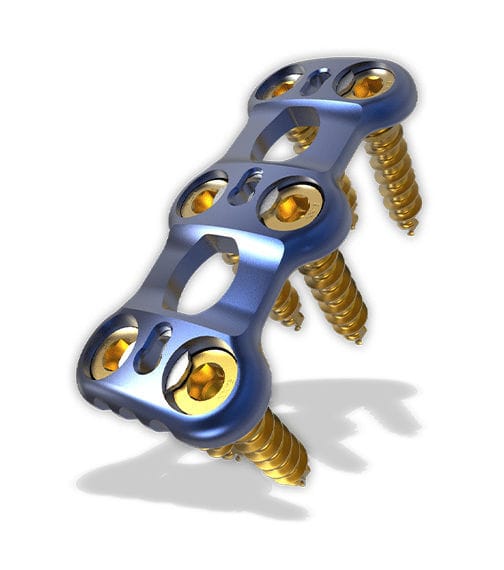 Cervical arthrodesis plate - Falcon™ - ChoiceSpine - locking / 2 levels