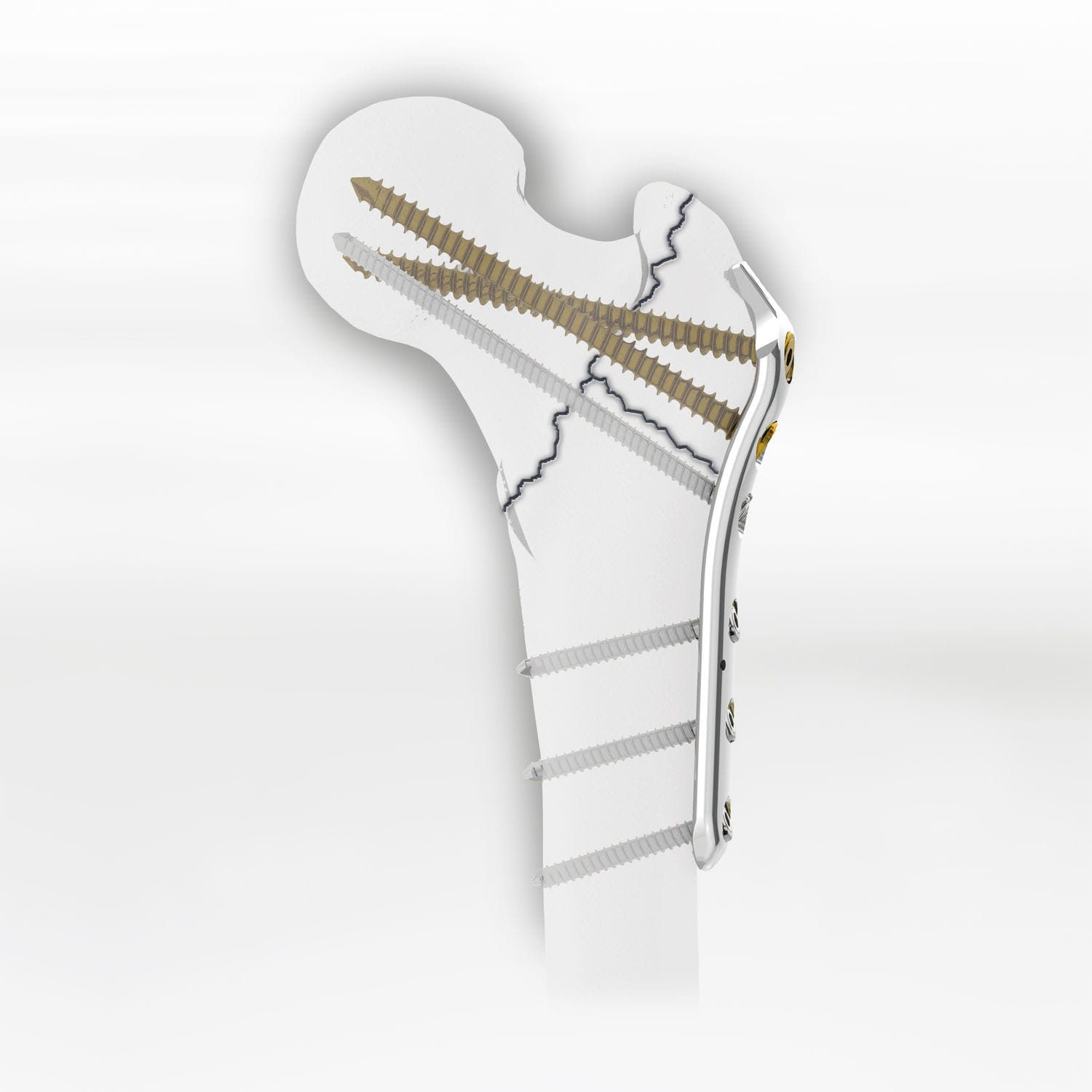 Femur compression plate - PFF - 155.20XX - Intrauma - trochanteric ...