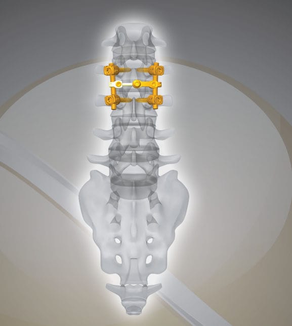 Lumbar osteosynthesis unit - NEX D2 - Next Orthosurgical - posterior ...