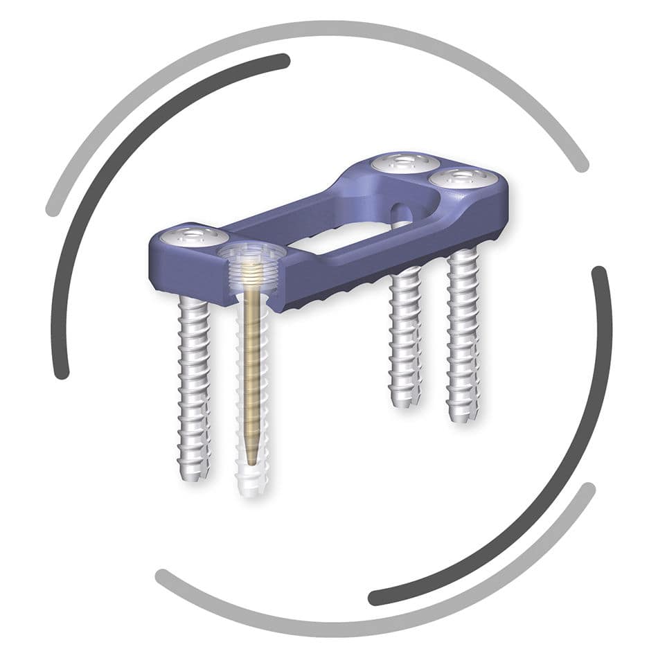 Thoraco-lumbar arthrodesis plate - CONTACT - Signus Medical ...