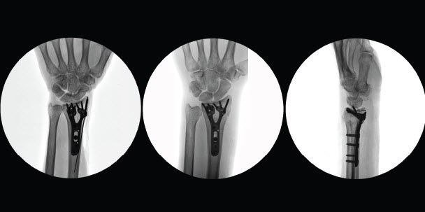 Radius compression plate - GEMINUS ® - Skeletal Dynamics - distal