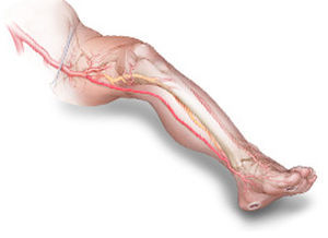 Saphenous vein vascular prosthesis / allograft - CryoVein® V010 - Cryolife