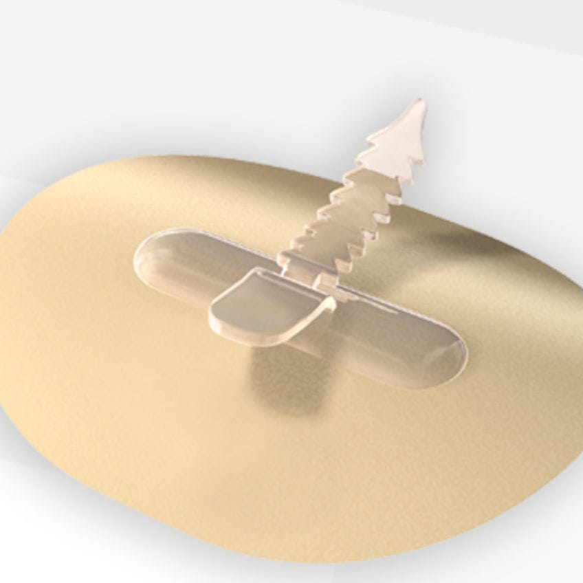 Adhesive catheter fixation - CathGrip® - BioDerm