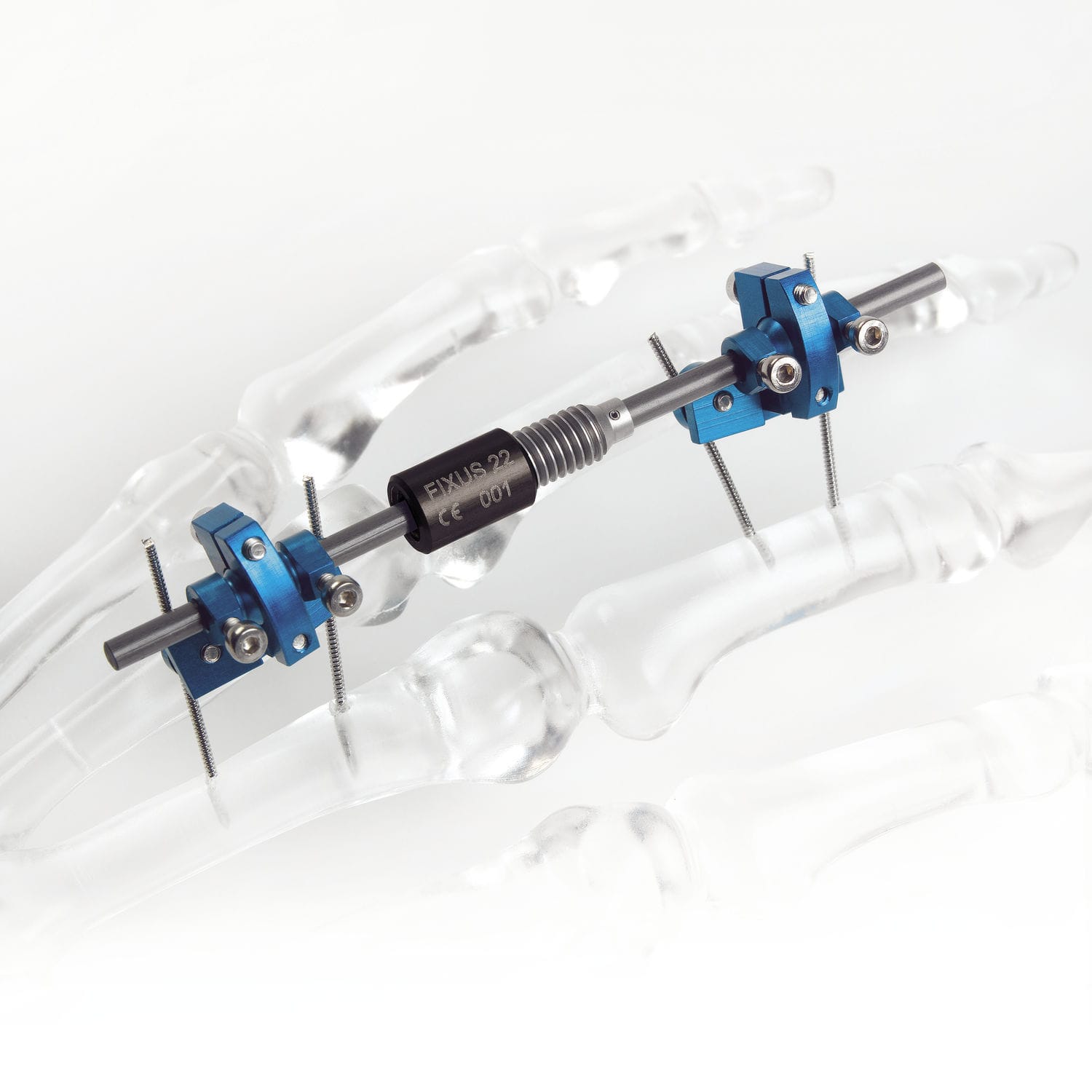 Metatarsophalangeal joint external fixation system - FIXUS22 - Fixus ...