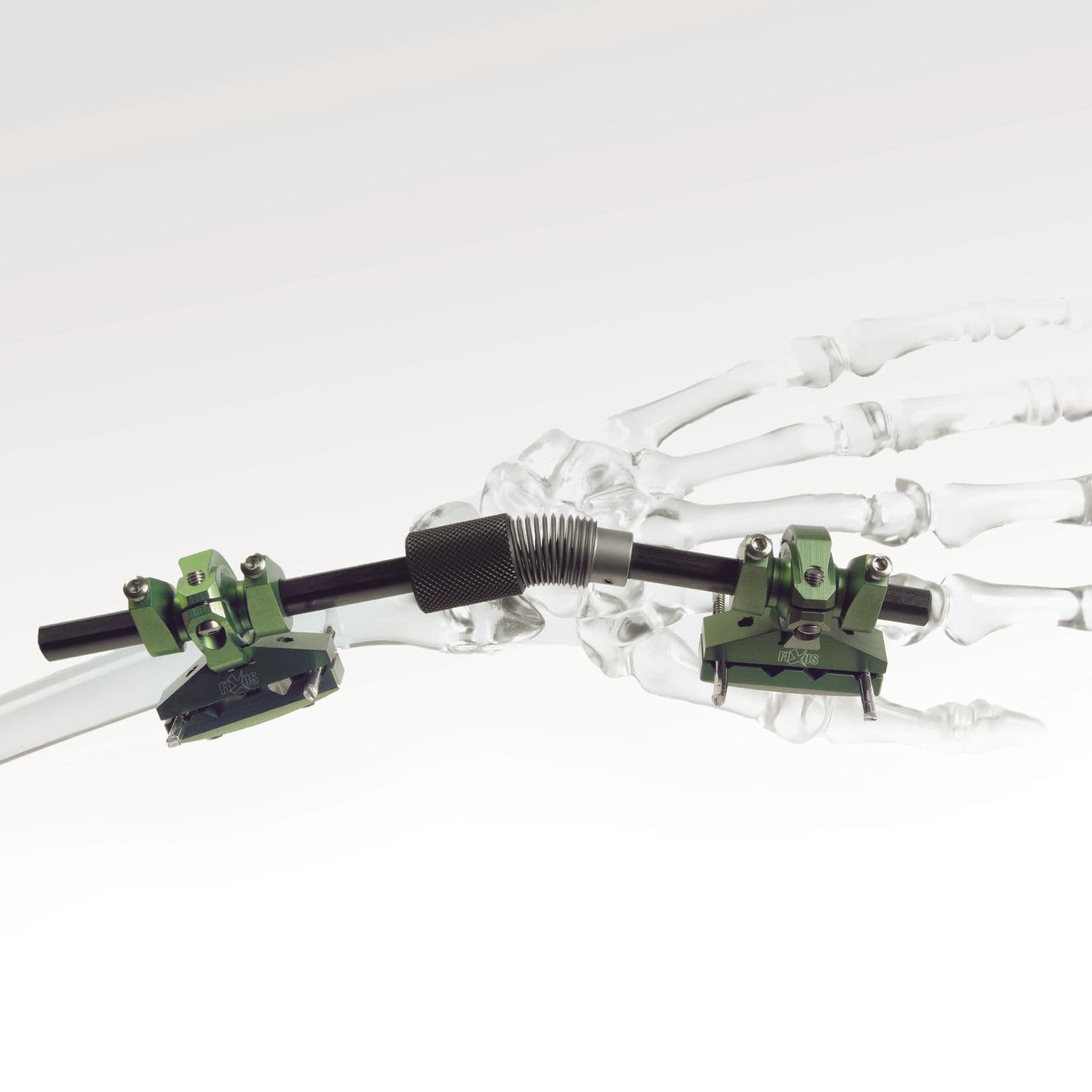 Radius external fixation system - FIXUS33 - Fixus - wrist / humerus ...