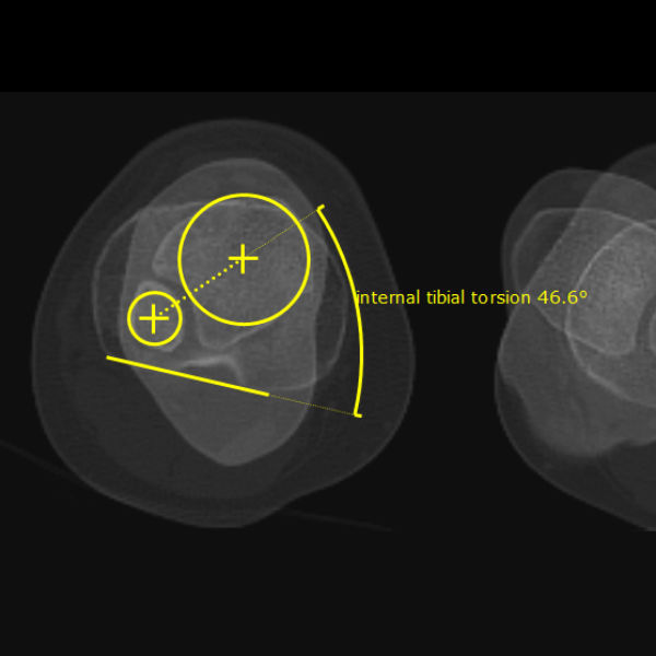 Planning software - mediCAD Hectec GmbH - merging / orthopedic / leg