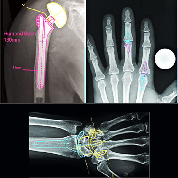 Planning software - mediCAD Hectec GmbH - orthopedic / hand / finger