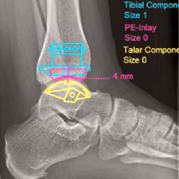 Planning software - mediCAD Hectec GmbH - orthopedic / foot / 2D