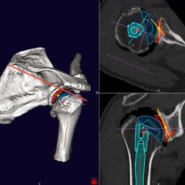 Planning software - mediCAD Hectec GmbH - orthopedic / shoulder / 3D
