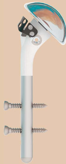Cementless humeral stem - HUMELOCK II - FX Solutions
