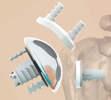 Humeral head prosthesis - EASYTECH™ - FX Solutions
