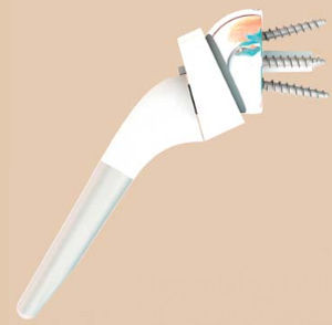 Reverse shoulder prosthesis - HUMERIS™ - FX Solutions - cementless