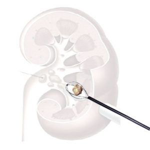 Kidney stone extraction endoscopic basket - PerkX - ROCAMED - tipless