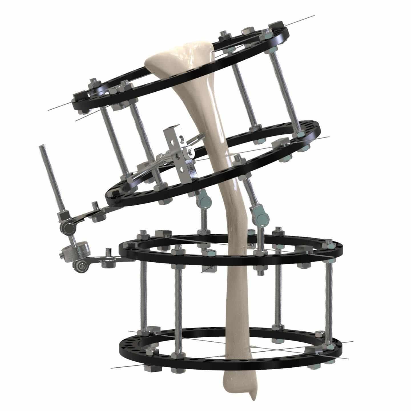 Tibia external fixation system - 11611 series - Canwell Medical ...
