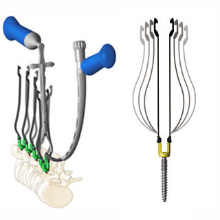 Minimally invasive pedicle screw positioning system - Zina™ - Shanghai ...