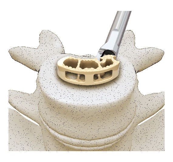 Lumbar interbody fusion cage - Dica - Shanghai Sanyou Medical ...
