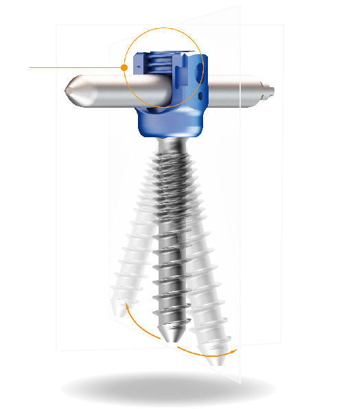 Lumbar pedicle screw - Lora™ MIS - Shanghai Sanyou Medical - thoracic ...