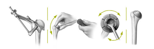 Shoulder prosthesis - Equinoxe® Primary - Exactech