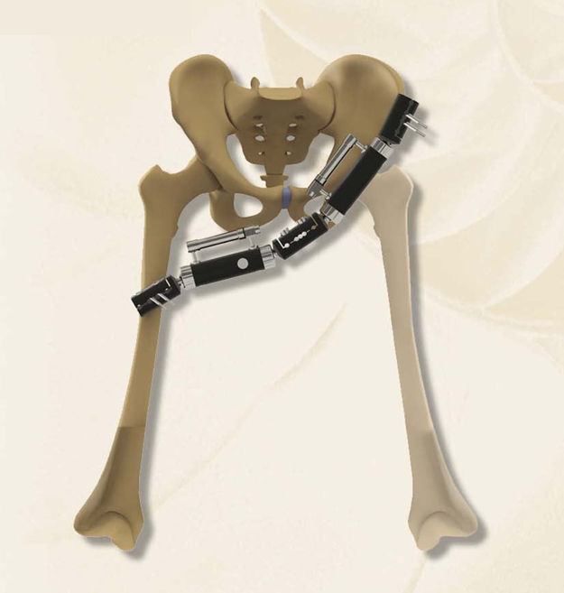 Pelvis external fixation system - 40140000100 - Biotech Medical ...