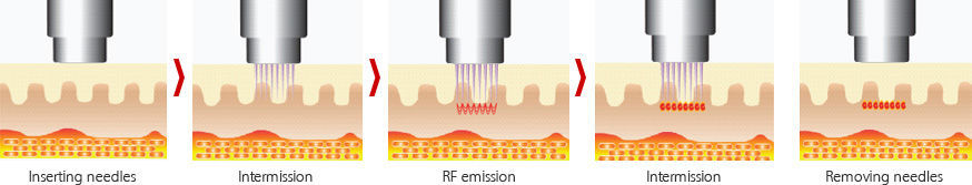Micro-needling unit - INTRAcel™ - JEISYS Medical - RF body contouring ...
