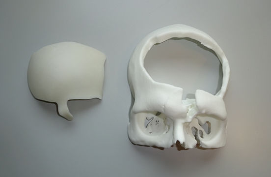 Custom-made cranial implant - SkullPT - 3D Side