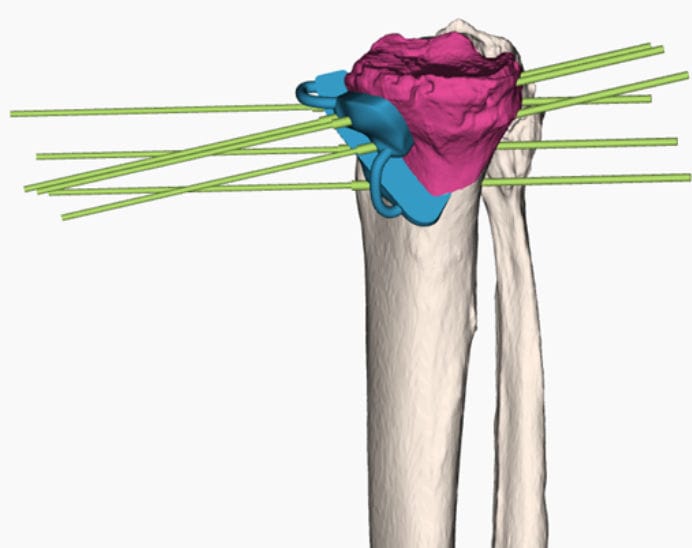 Tibial osteotomy resection guide - 3D Side