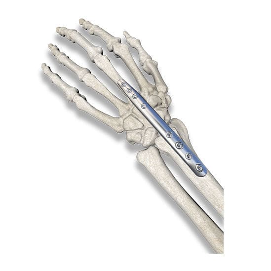 Wrist arthrodesis plate - PediFrag - OrthoPediatrics - metallic / pediatric