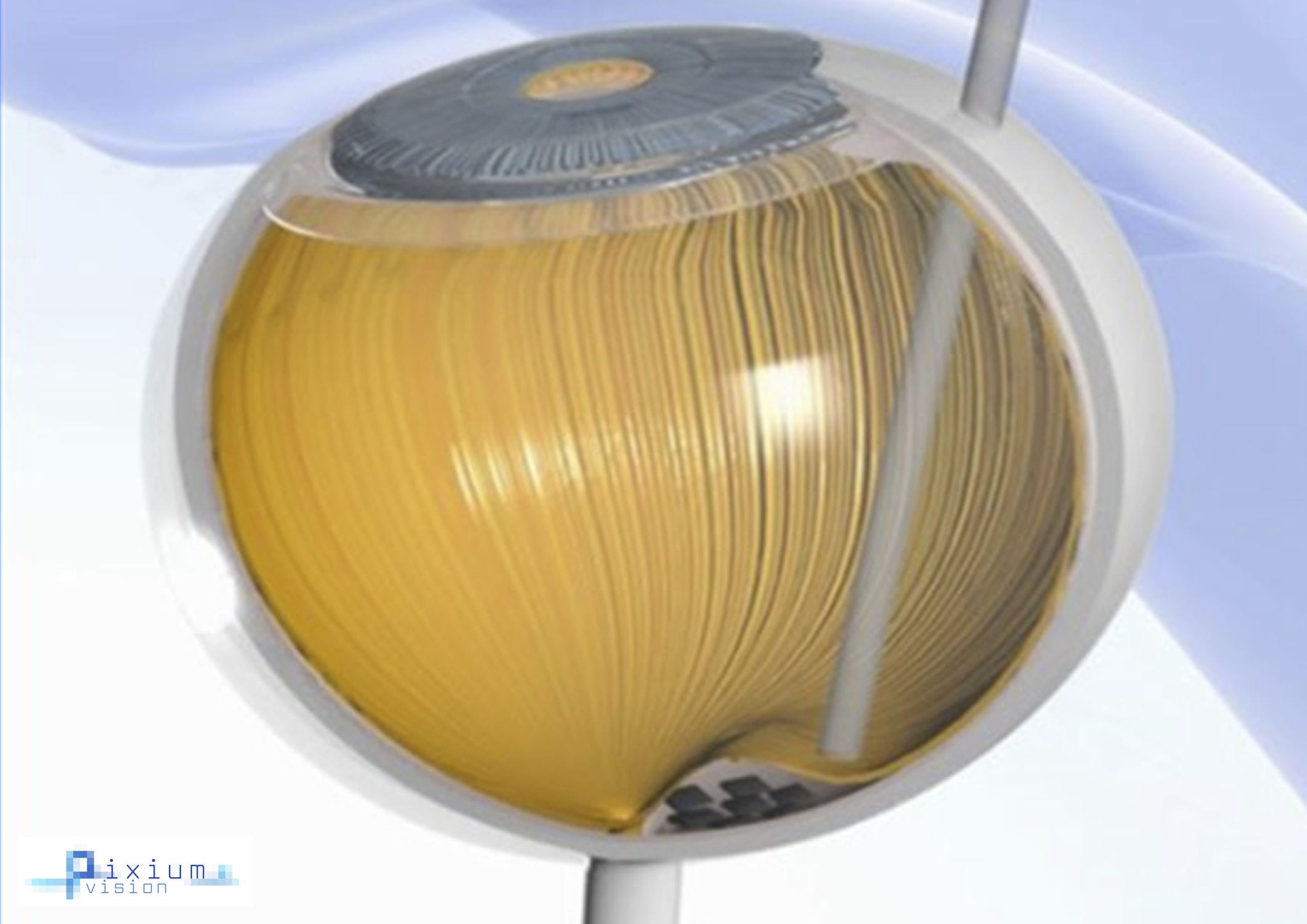 Subretinal implant - PRIMA - Pixium Vision