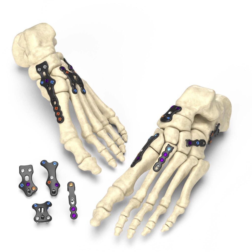 Hindfoot arthrodesis plate - Stratum® - Nextremity Solutions - forefoot ...