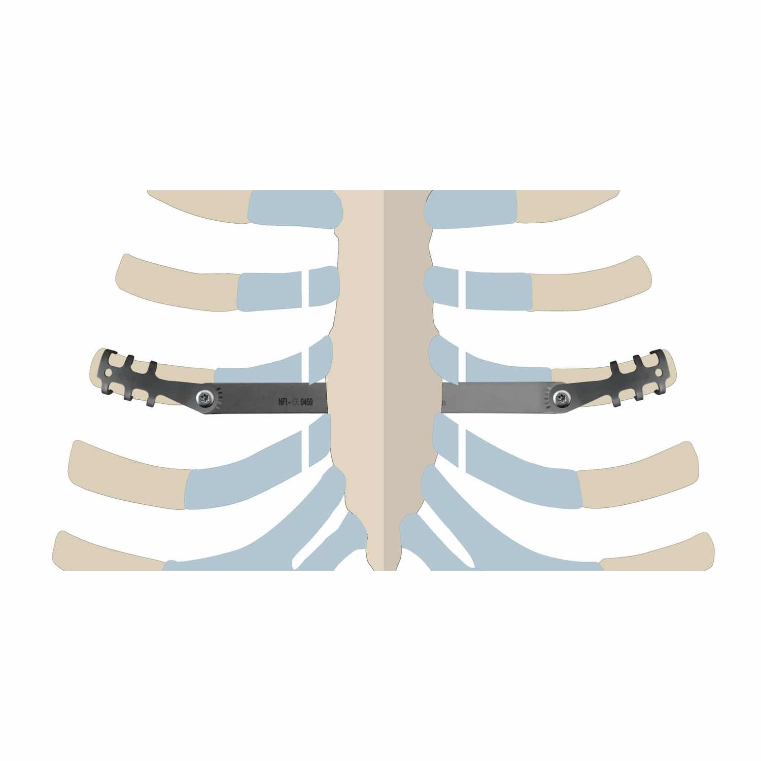 Titanium Rib Plating Photos Of My Surgery Video