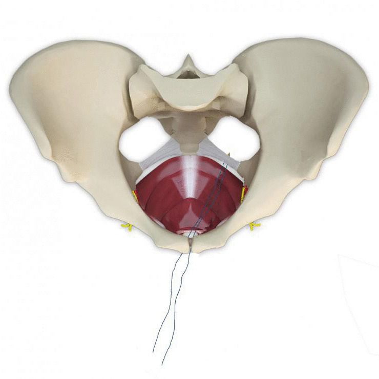 Prolapse reconstruction mesh - Anchorsure - Neomedic International ...