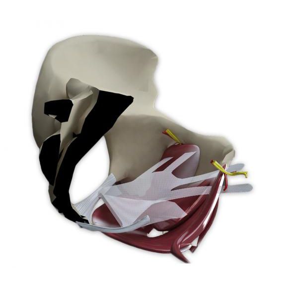 Prolapse reconstruction mesh - Surelift - Neomedic International ...