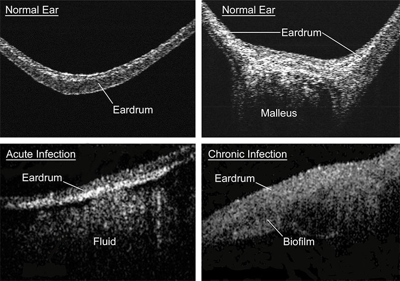 Video otoscope - Tomiscope - PhotoniCare - pediatric / with OCT imaging ...