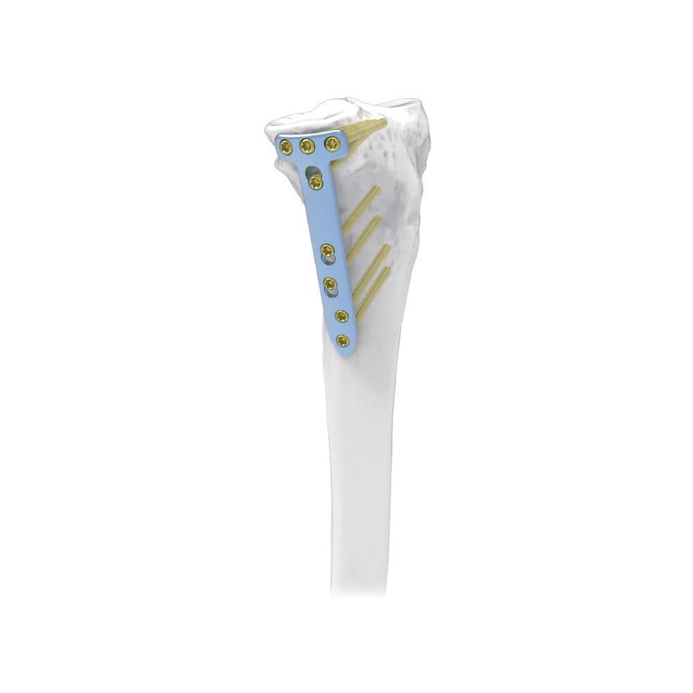 Tibia osteotomy plate - NORMMED Medical Devices - locking / metallic