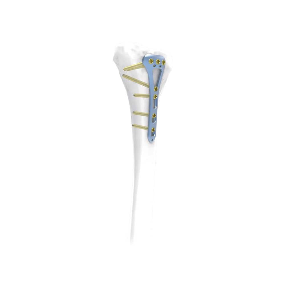 Tibia compression plate - NORMMED Medical Devices - distal ...