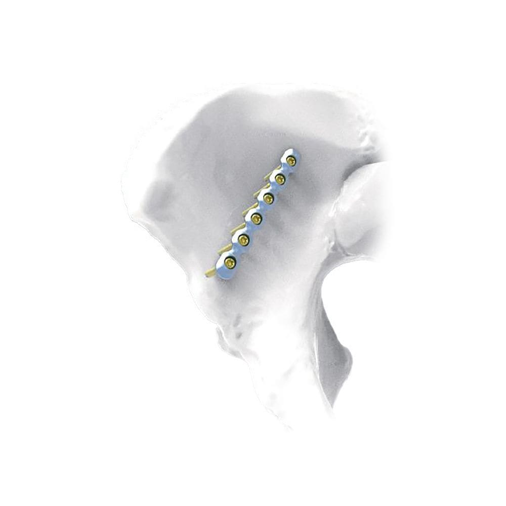 Pelvis compression plate - Straight - NORMMED Medical Devices - locking ...