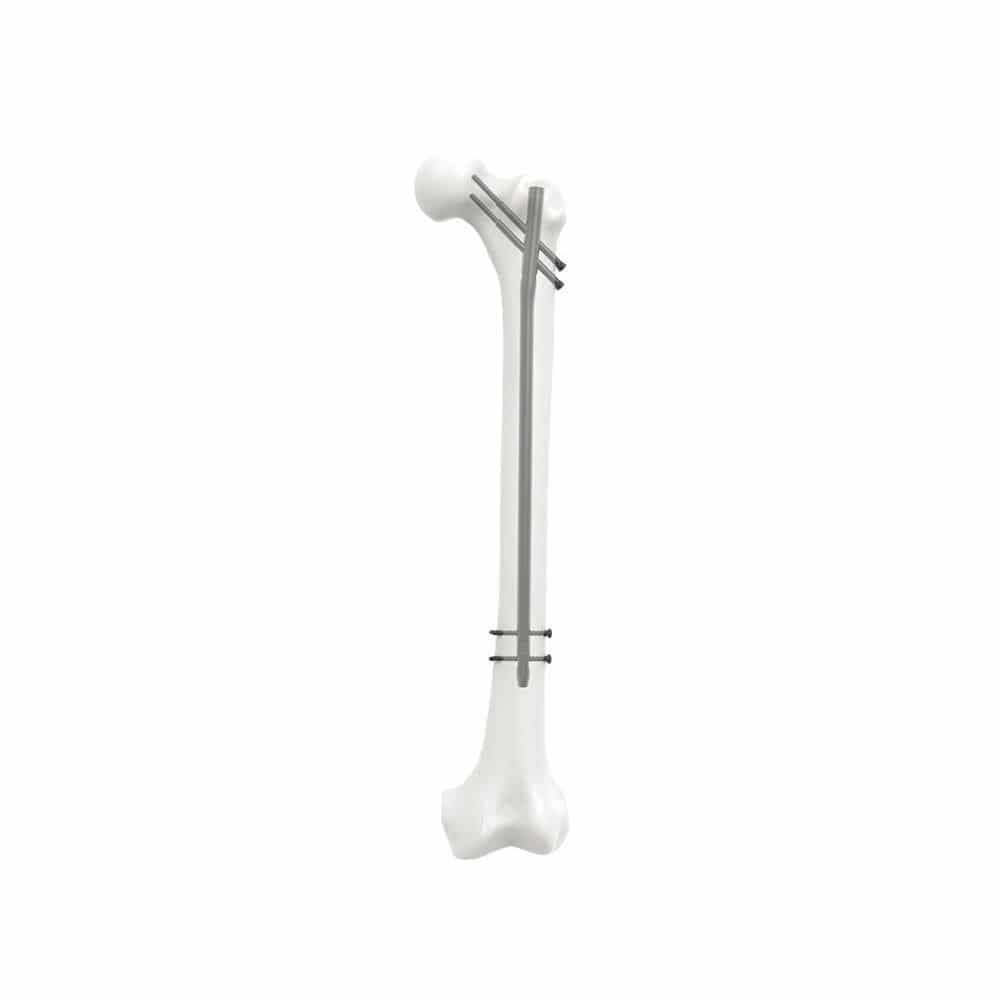 Femoral intramedullary nail - NORMMED Medical Devices - proximal ...