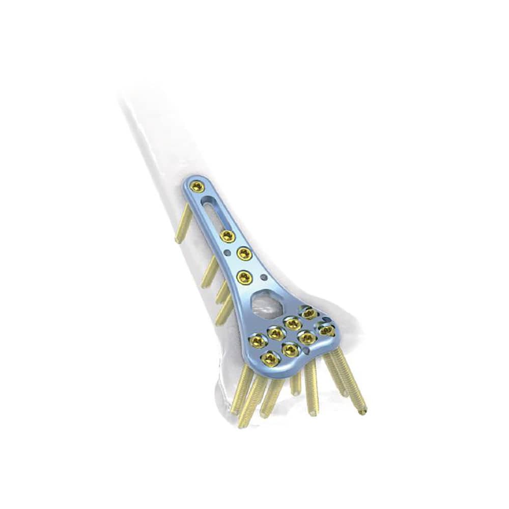 Radius compression plate - NORMMED Medical Devices - distal / locking ...