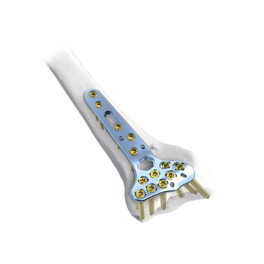 Radius compression plate - Rim - NORMMED Medical Devices - distal ...