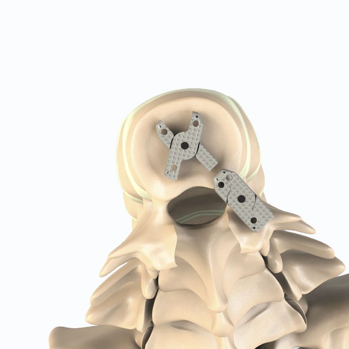 Lumbar interbody fusion cage - XLIF - Aditus Medical - posterior ...