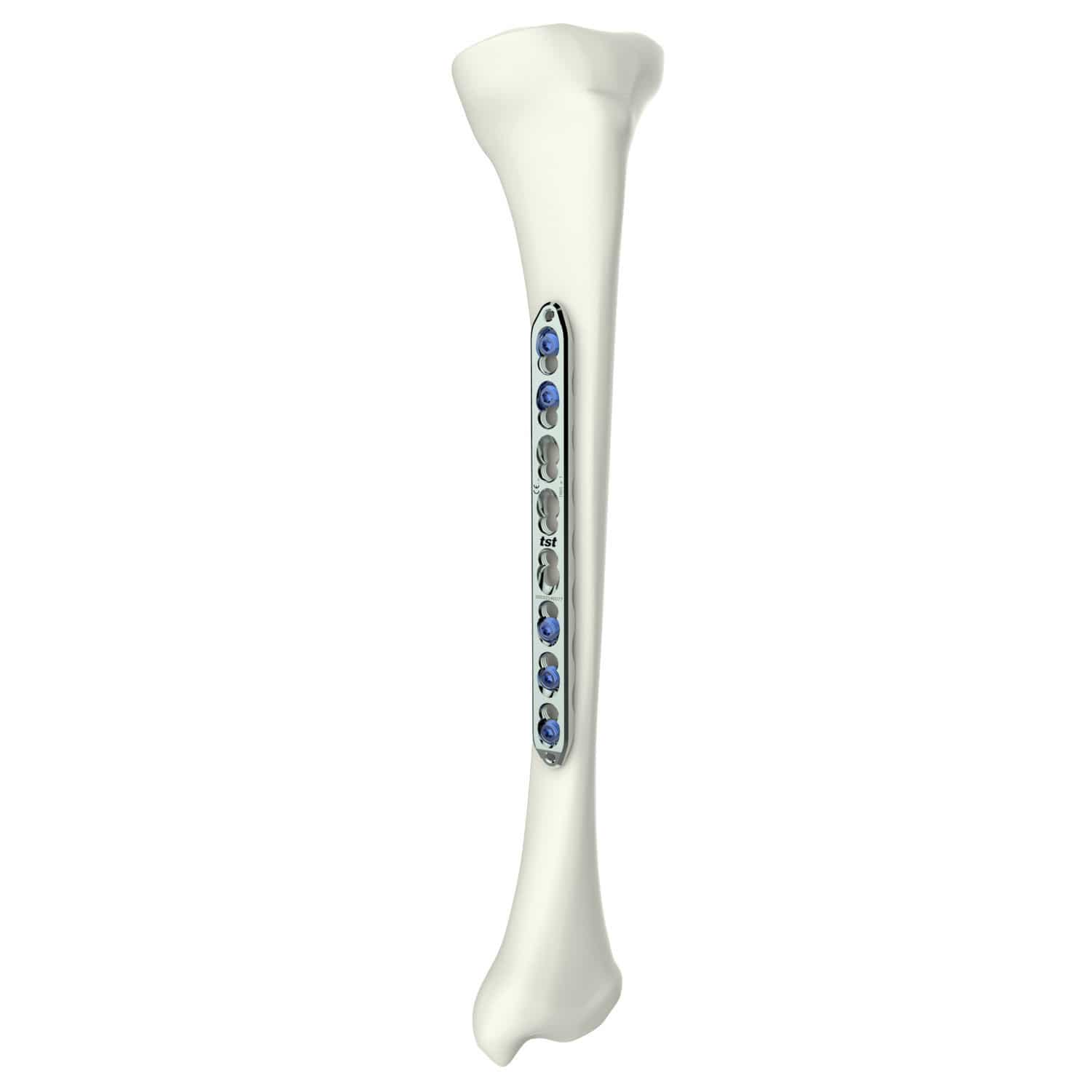 Humerus compression plate - 317270000 series - Peditst - tibia ...